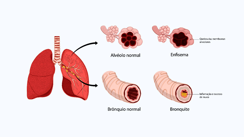 Doença Pulmonar Obstrutiva Crônica | Abraçar a Vida