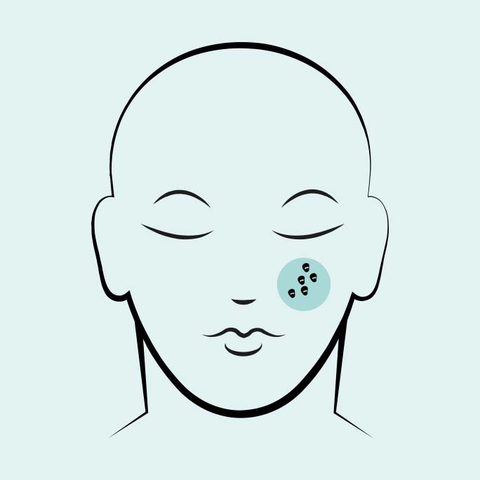 Symptomer forbundet med sklerodermi | MTS