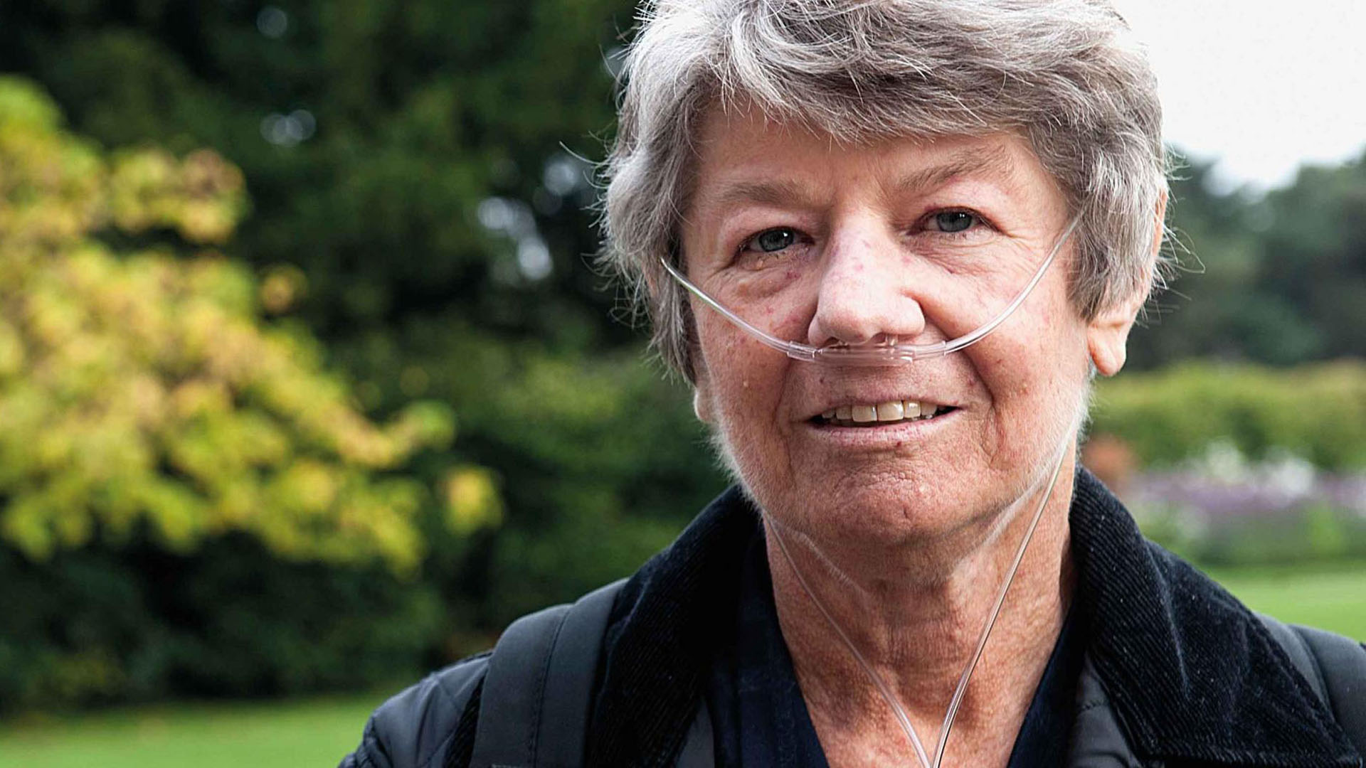 Symptomer forbundet med sklerodermi | MTS