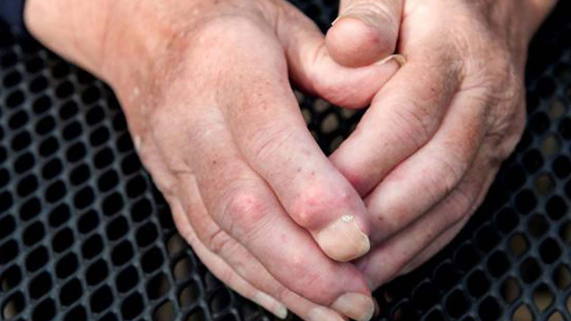 Symptomer forbundet med sklerodermi | MTS