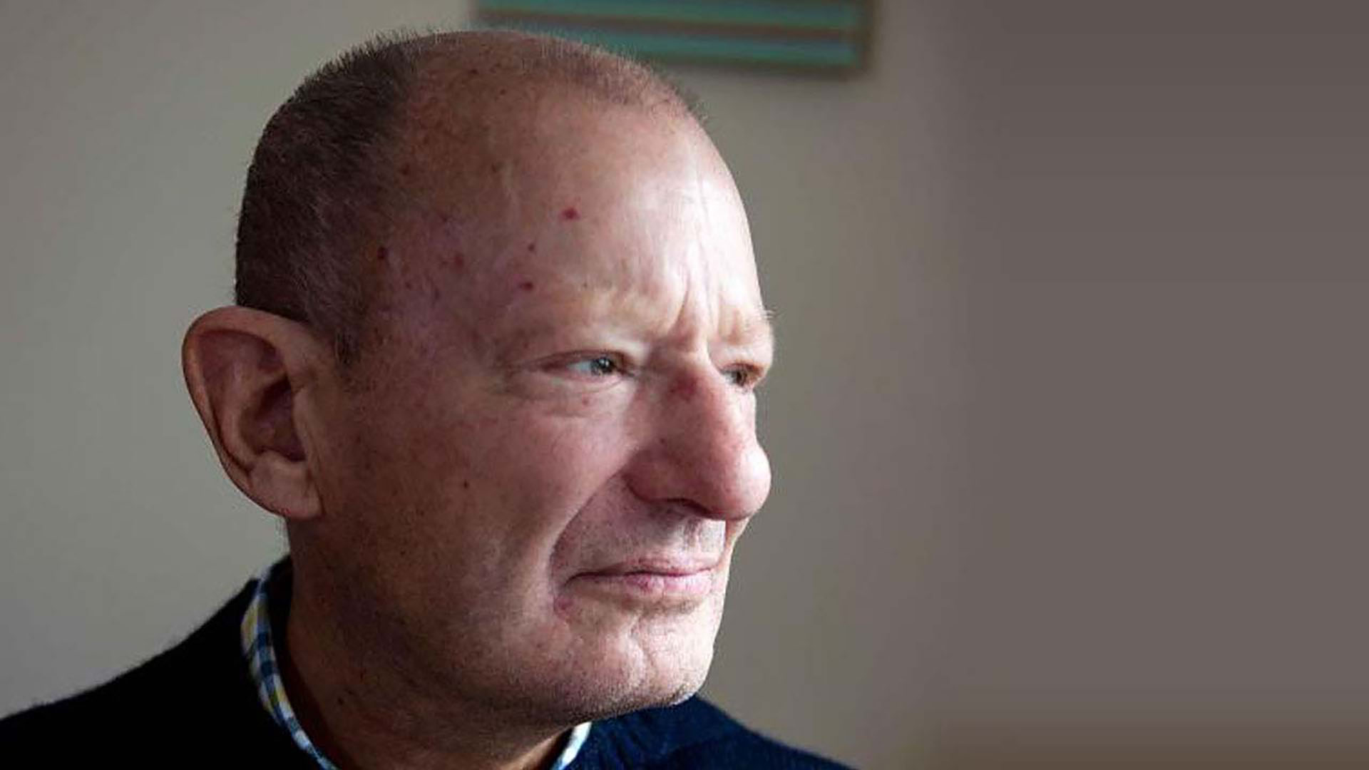 Symptomer forbundet med sklerodermi | MTS