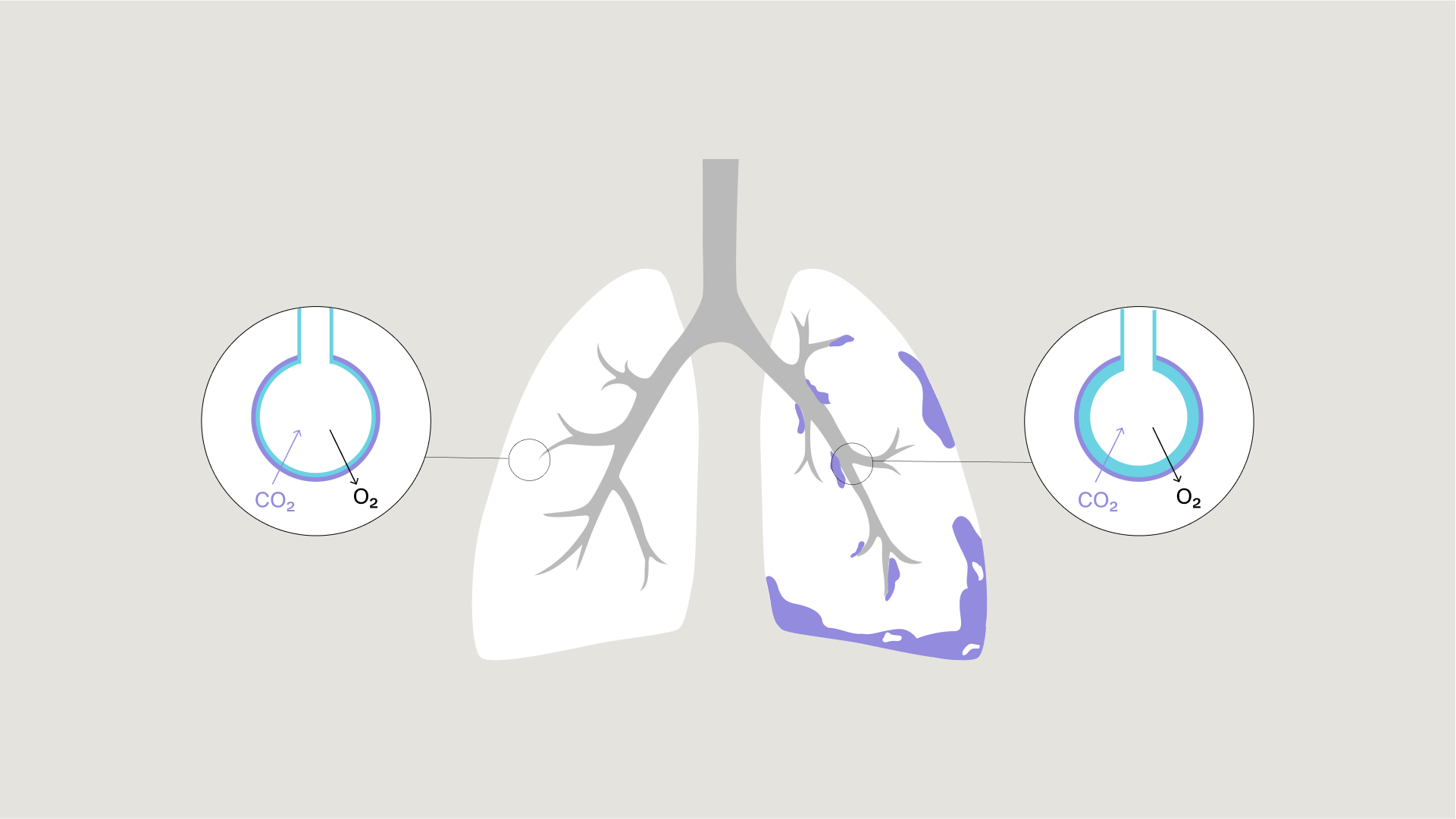 Lungefibrose relaterede tilstande | Livet lungefibrose