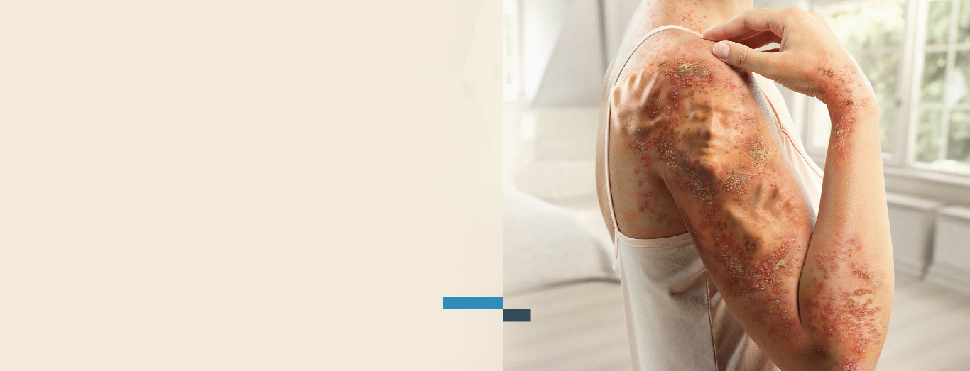 Gpp And Me Learn About Generalized Pustular Psoriasis