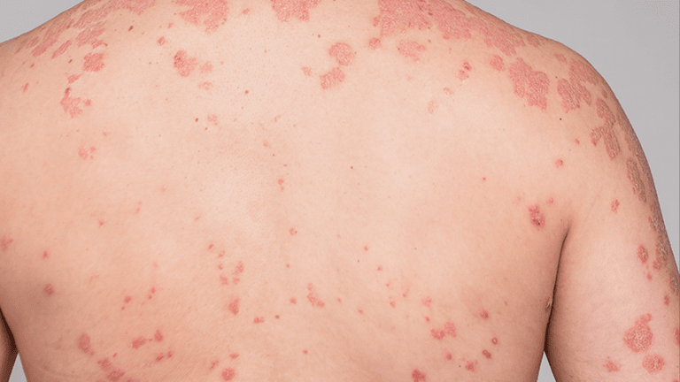 Generalized Pustular Psoriasis is different from Plaque psoriasis | Gpp ...