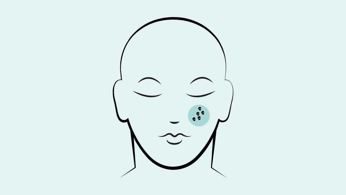 How to cope with scleroderma symptoms | More Than Scleroderma