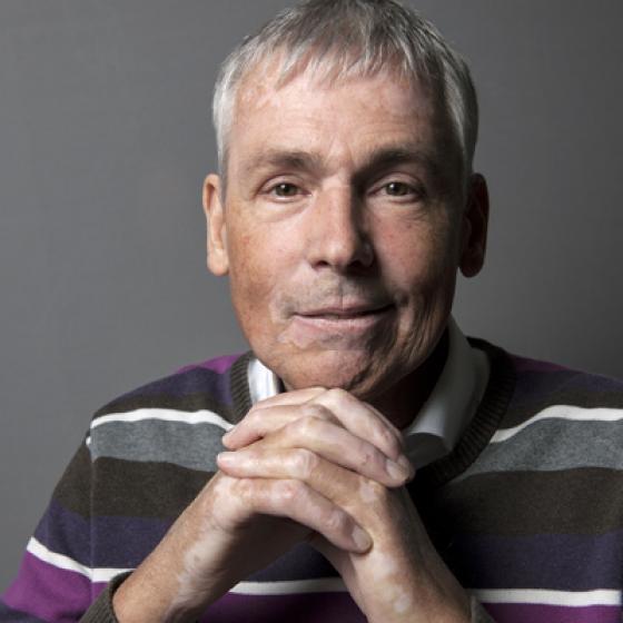 Alex's testimony - patient story | More Than Scleroderma