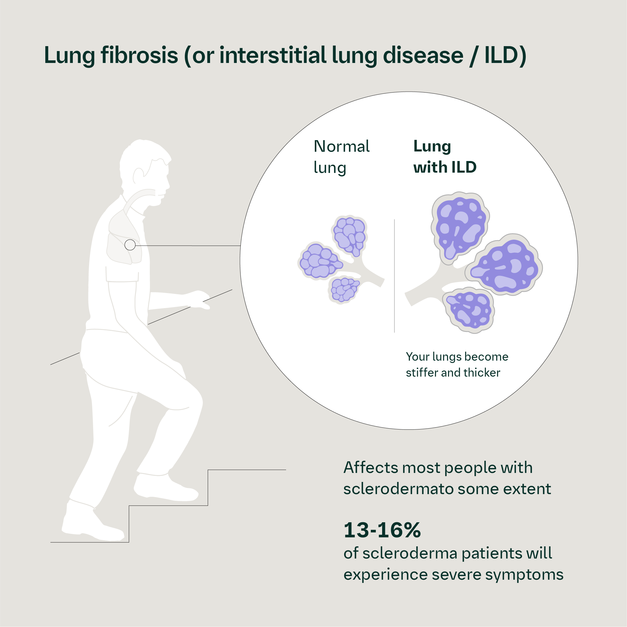 Lung problems in systemic sclerosis | More Than Scleroderma