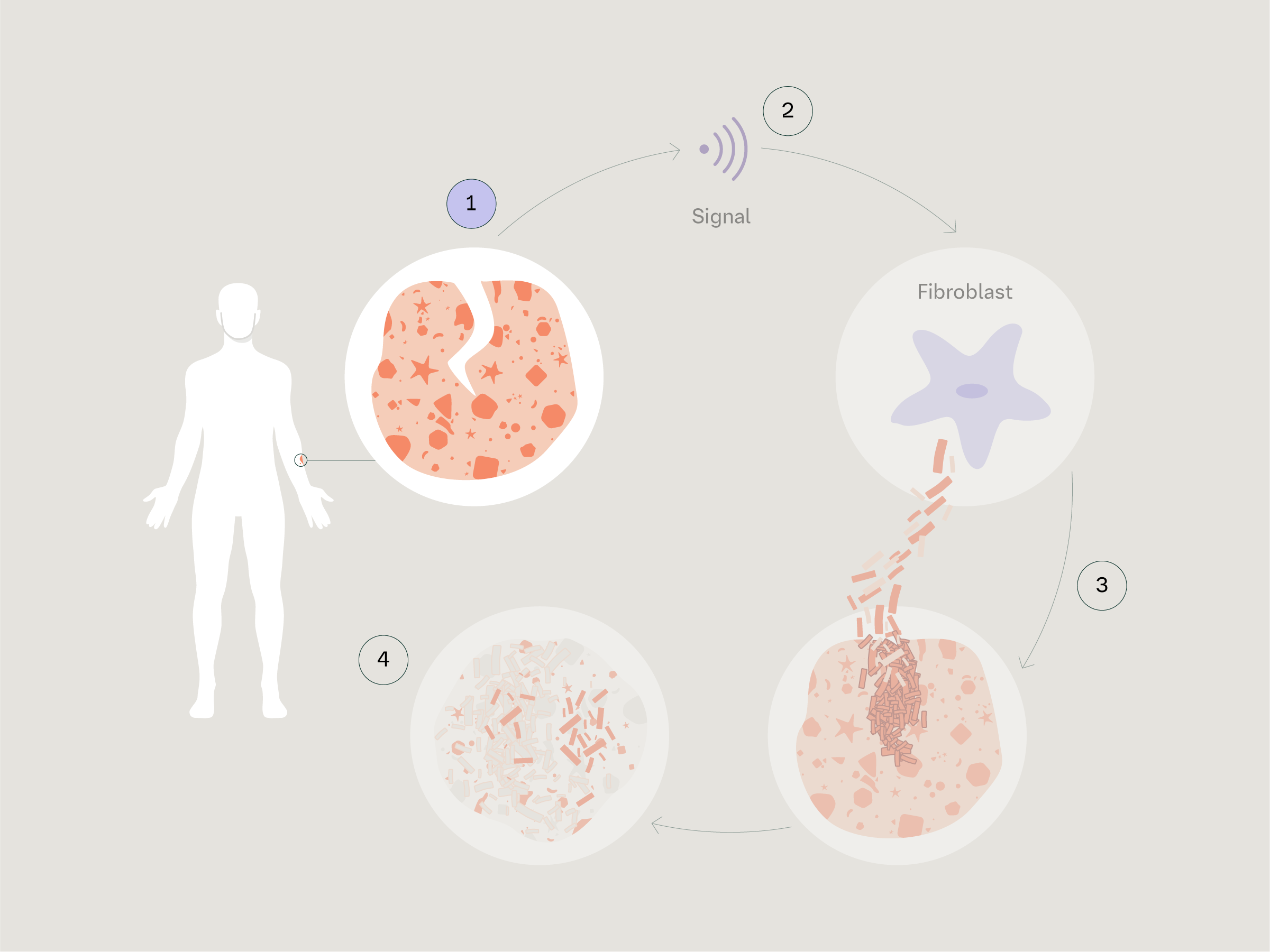 What is systemic sclerosis | More Than Scleroderma