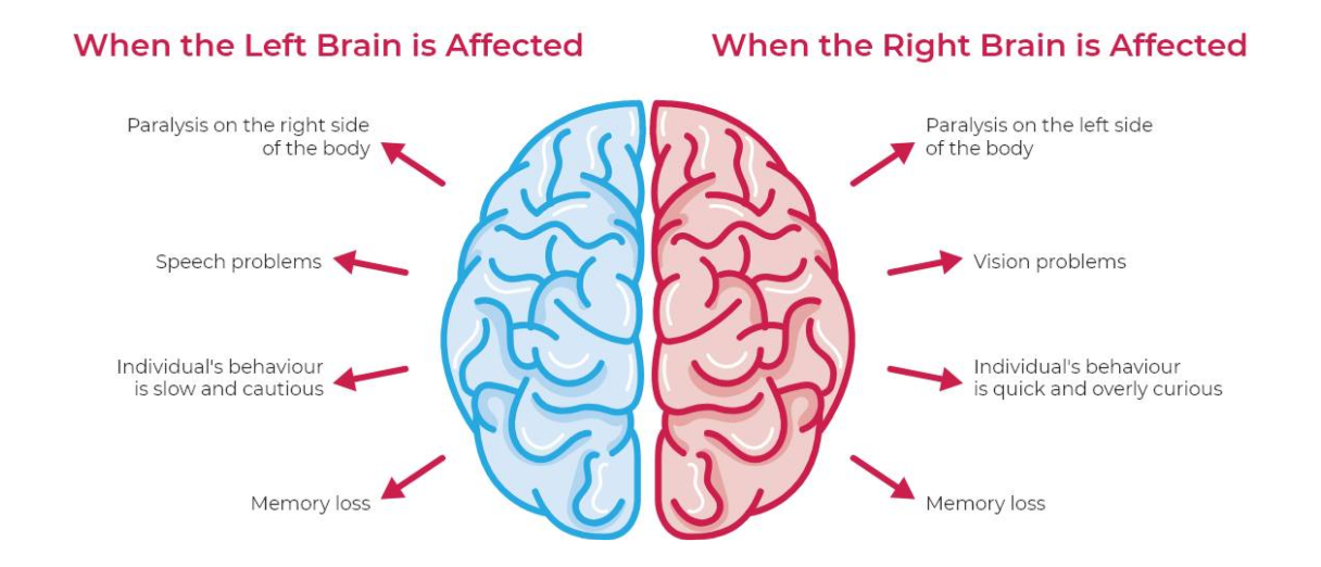 Understanding Stroke | Boehringer-Ingelheim