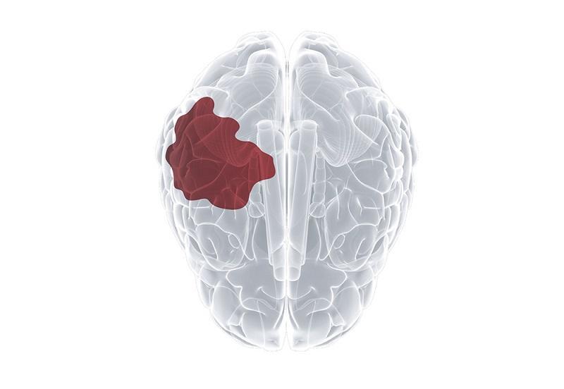 TROMBOSE EN BEROERTE Beroerte, CVA, | Boezemfibrilleren