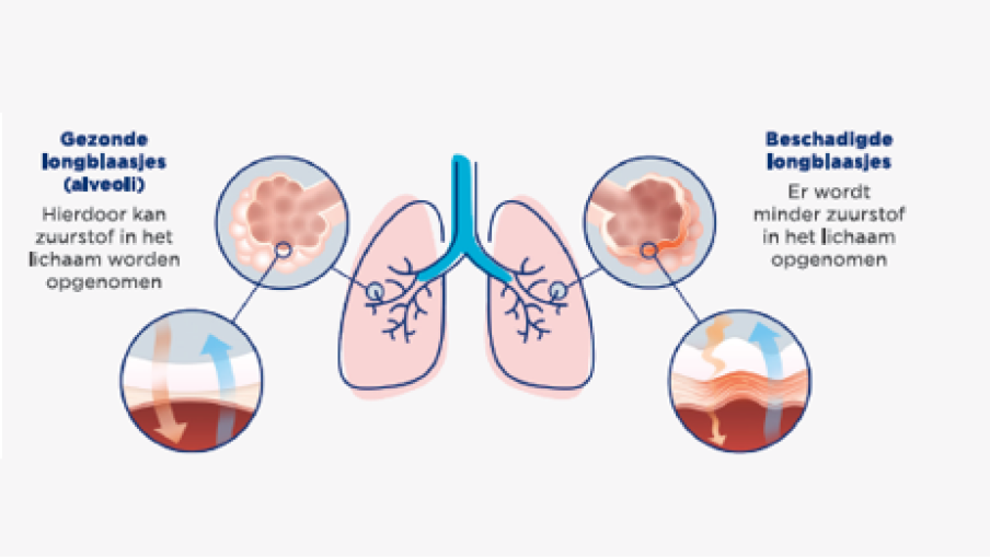 Wat is longfibrose? | Informatie voor patiënten in NL