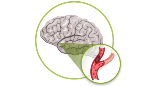 Un accidente cerebrovascular es urgencia médica | ACV
