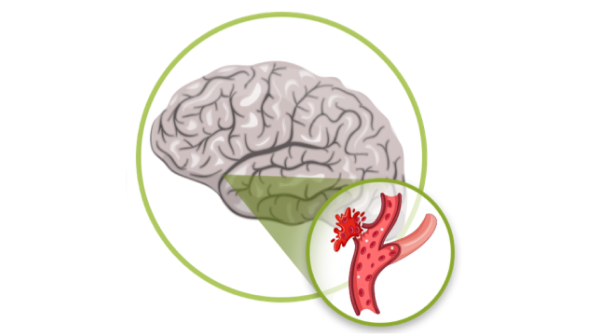Un accidente cerebrovascular es urgencia médica | ACV
