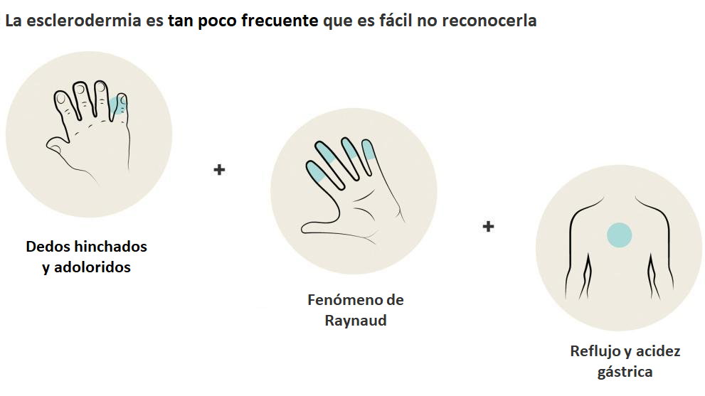 ¿Qué es la esclerosis sistémica? Más que esclerodermia
