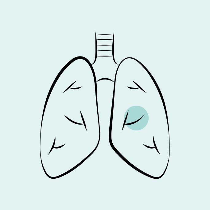 Symtom systemisk skleros | More Than Scleroderma