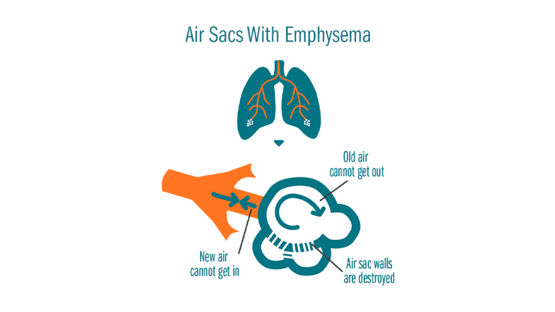 Understanding COPD | COMBIVENT RESPIMAT®