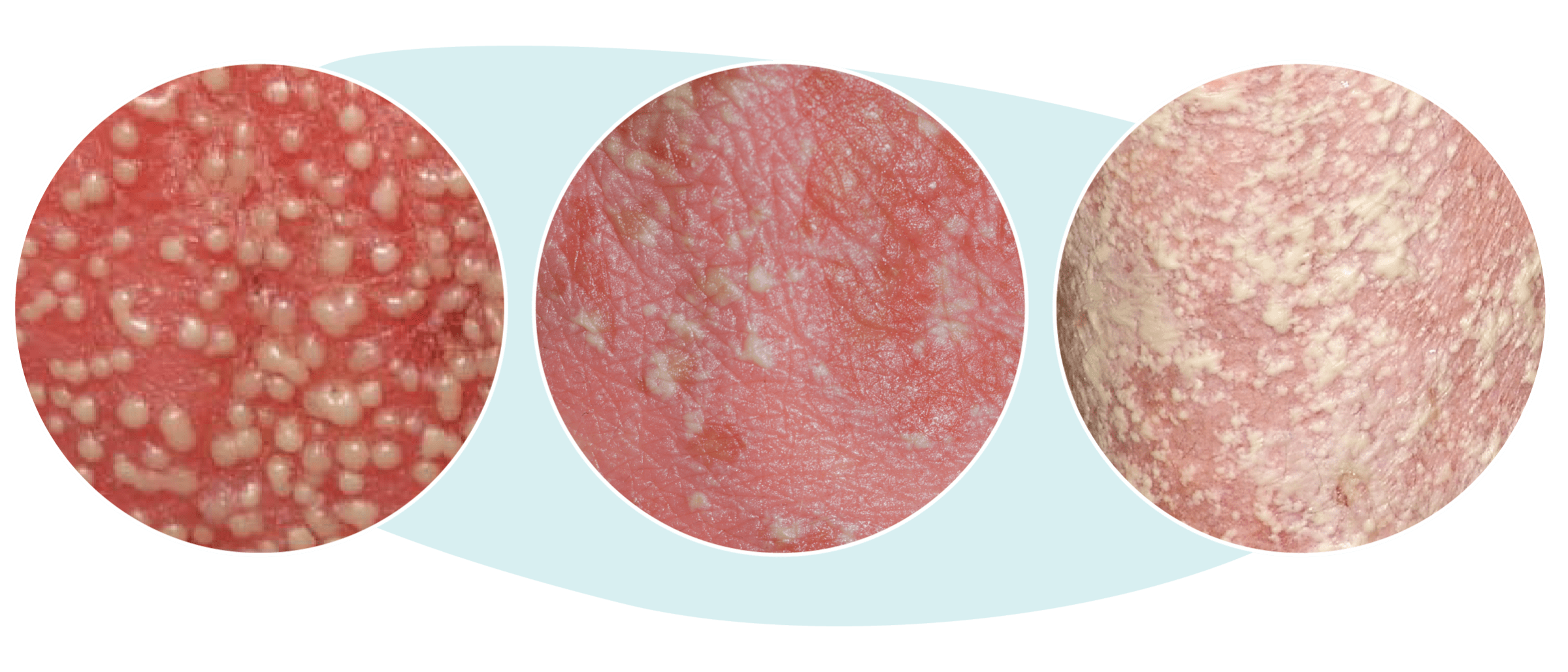 What Is Generalized Pustular Psoriasis (GPP)? | GPP & Me