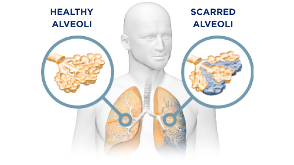 Chronic ILD with Worsening Fibrosis | OFEV® (nintedanib) capsules