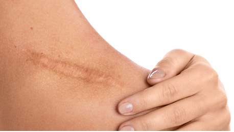 The Impact of Progression Over Time | Lungs&You