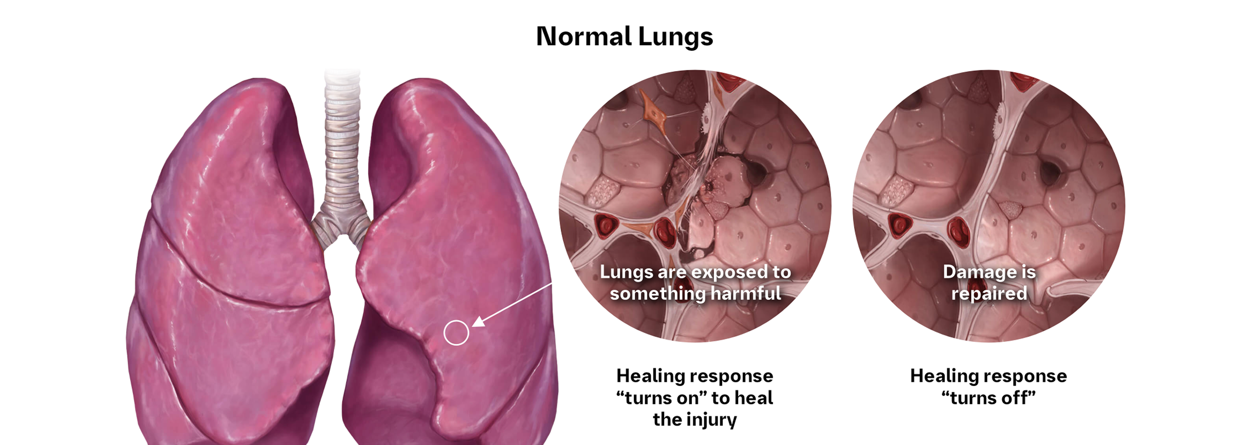 The Impact of Progression Over Time | Lungs&You